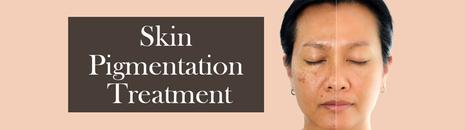 Skin Pigmentation Treatment - Kallosclinics